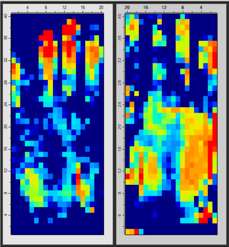 Colonoscopy Compression Device | ColoWrap
