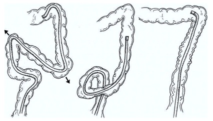 Looping in Colonoscopy: A Primer